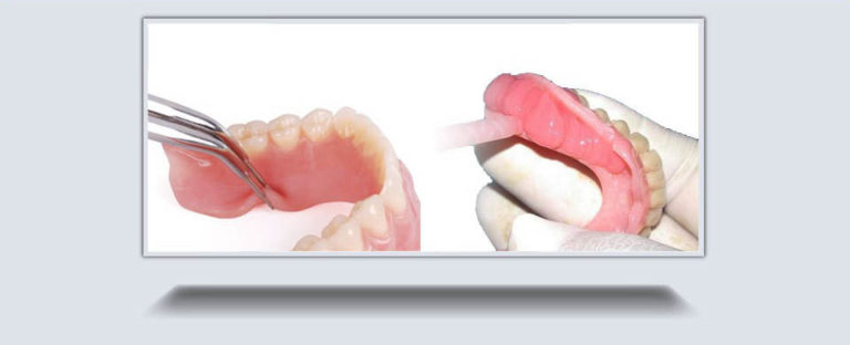 Temporary Soft Liners Hamilton | Soft Liners | Waterdown Denture Clinic